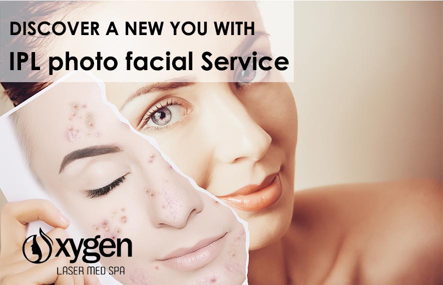 IPL photo facial - Oxygen Med Spa Orland Park | Laser, Facials, & More